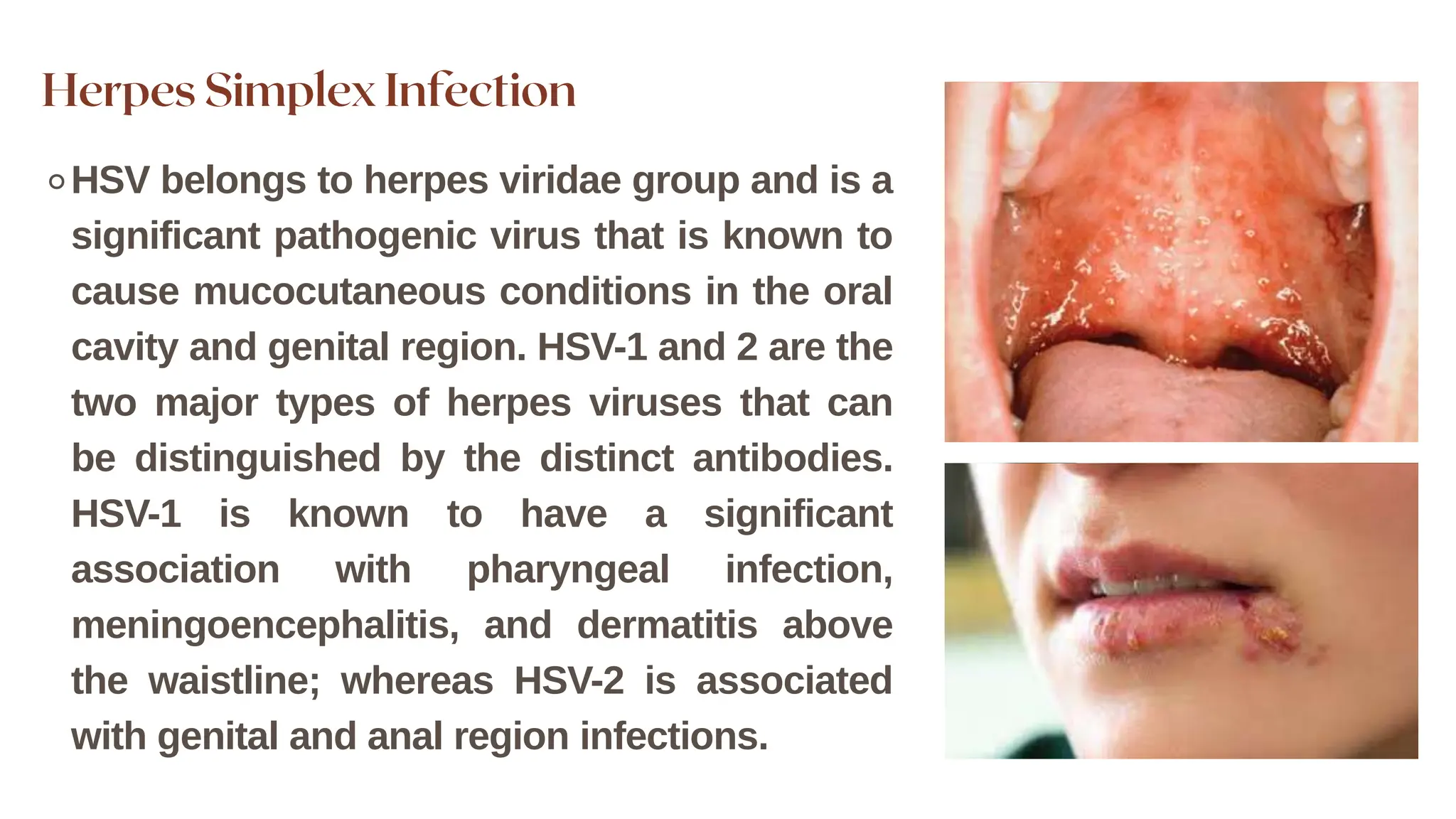 Viral infection of oral cavity .....pptx