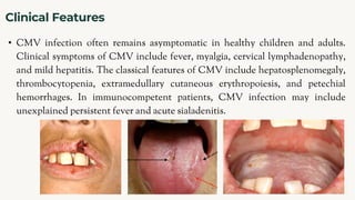 Viral infection of oral cavity .....pptx