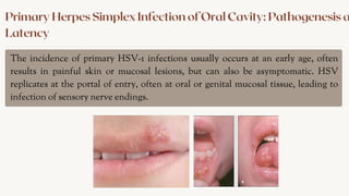 Viral infection of oral cavity .....pptx