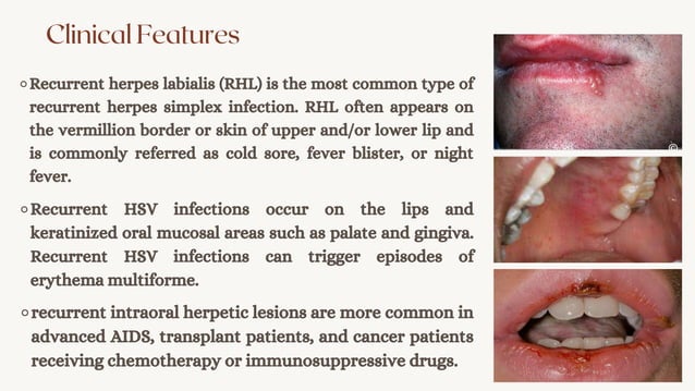 Viral infection of oral cavity .....pptx | Infectious Diseases ...