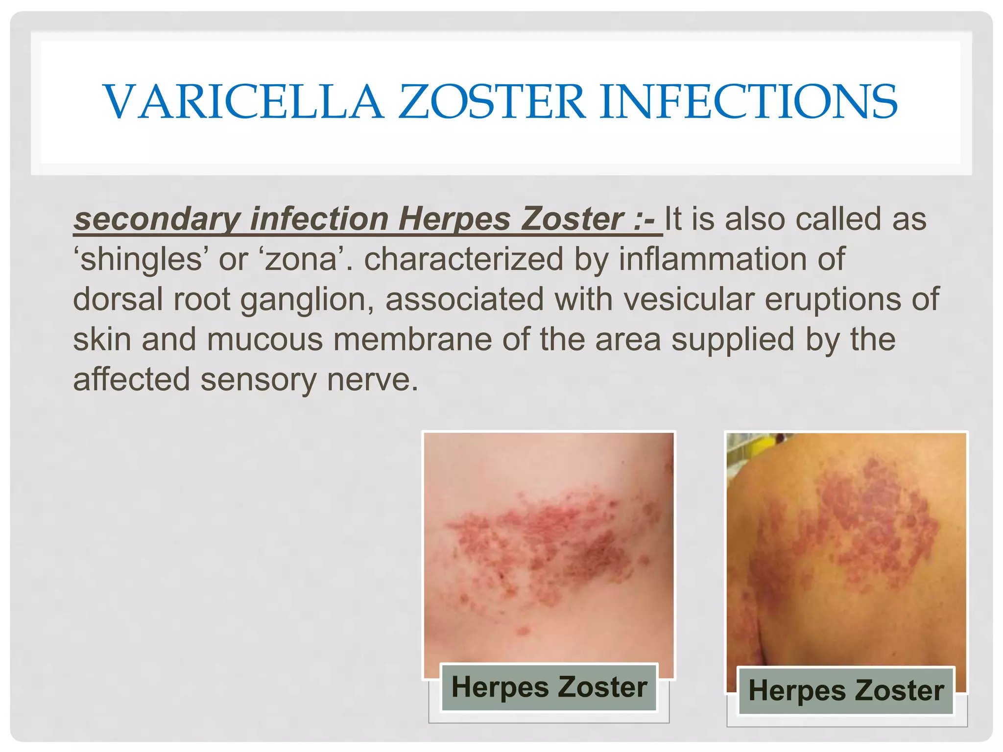 Viral infection ppt | PPTX