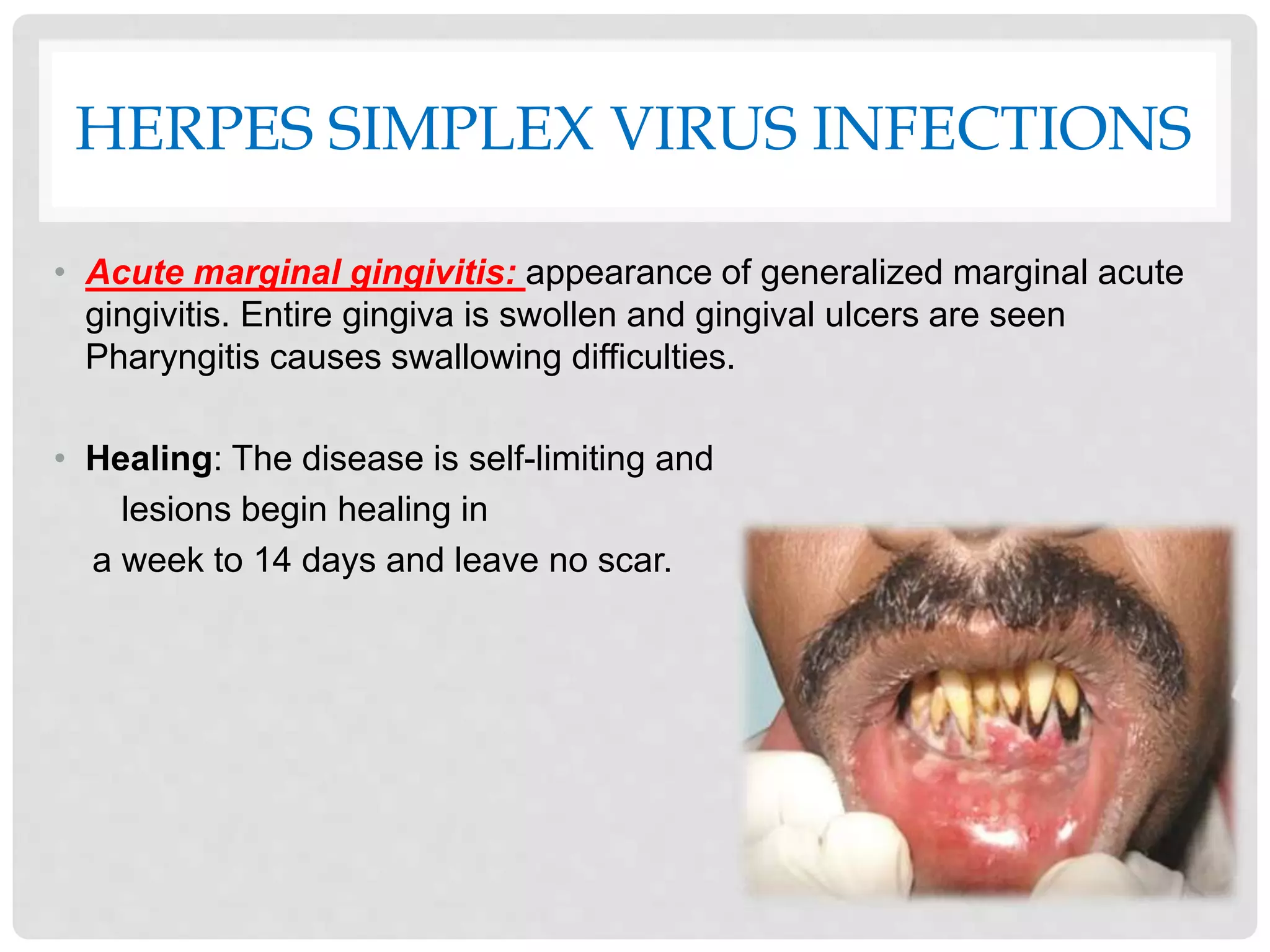 Viral infection ppt | PPTX