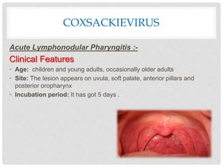 Acute Lymphonodular Pharyngitis