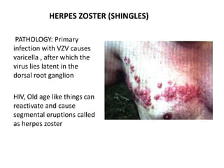 Viral Infection PPT . | PPTX