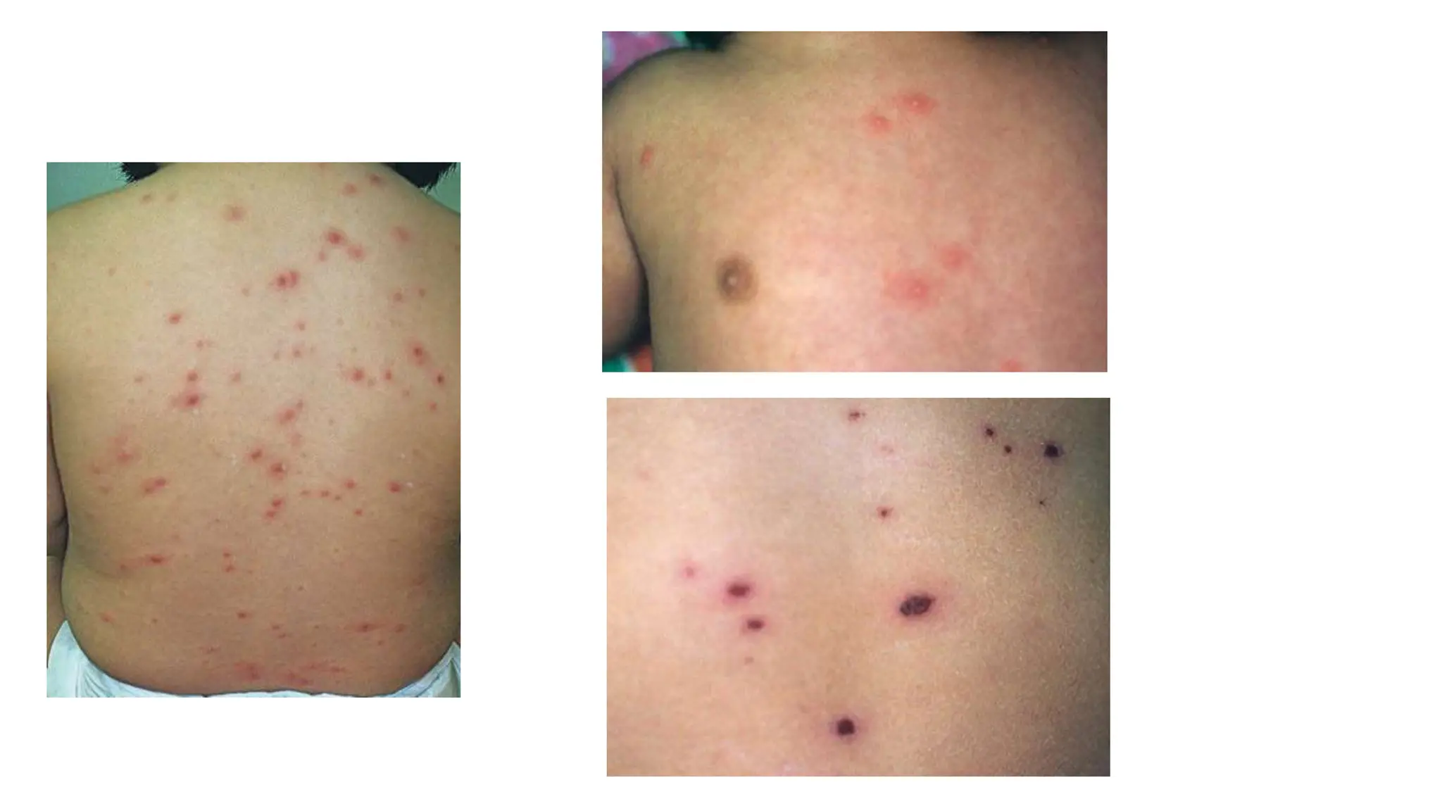 VIRAL INFECTIONS-IN DERMATOLOGY MD .pptx