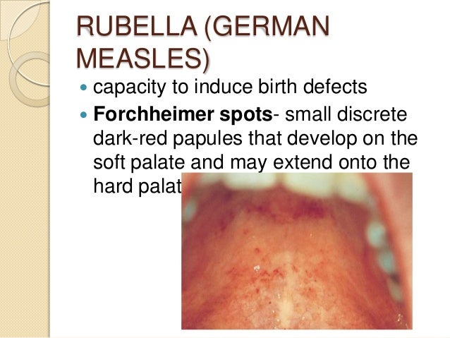 Viral infections of Oral Cavity