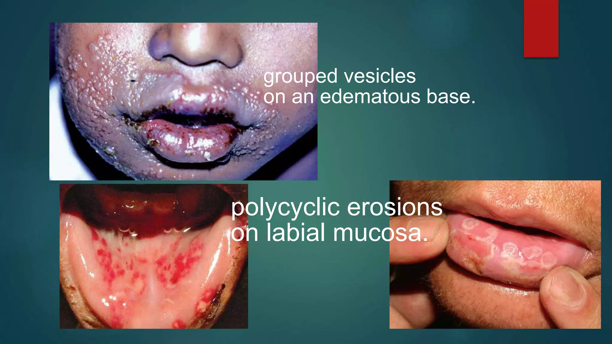 Viral infections | PPTX