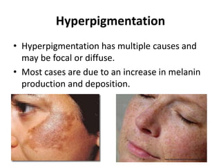 Focal Hyperpigmentation