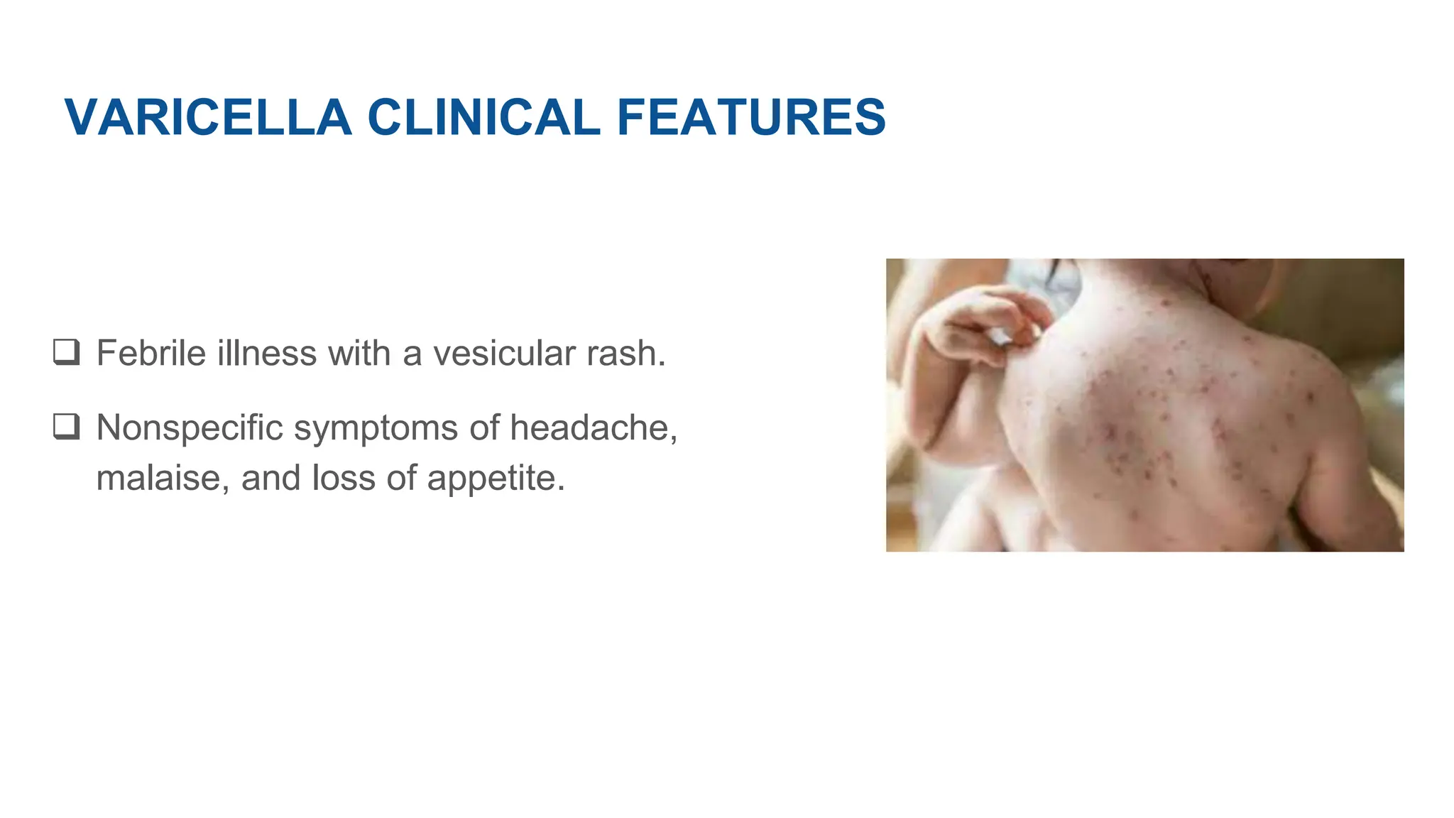 Serious viral infections- Influenza, measles, VZ, CMV, HZ.pptx