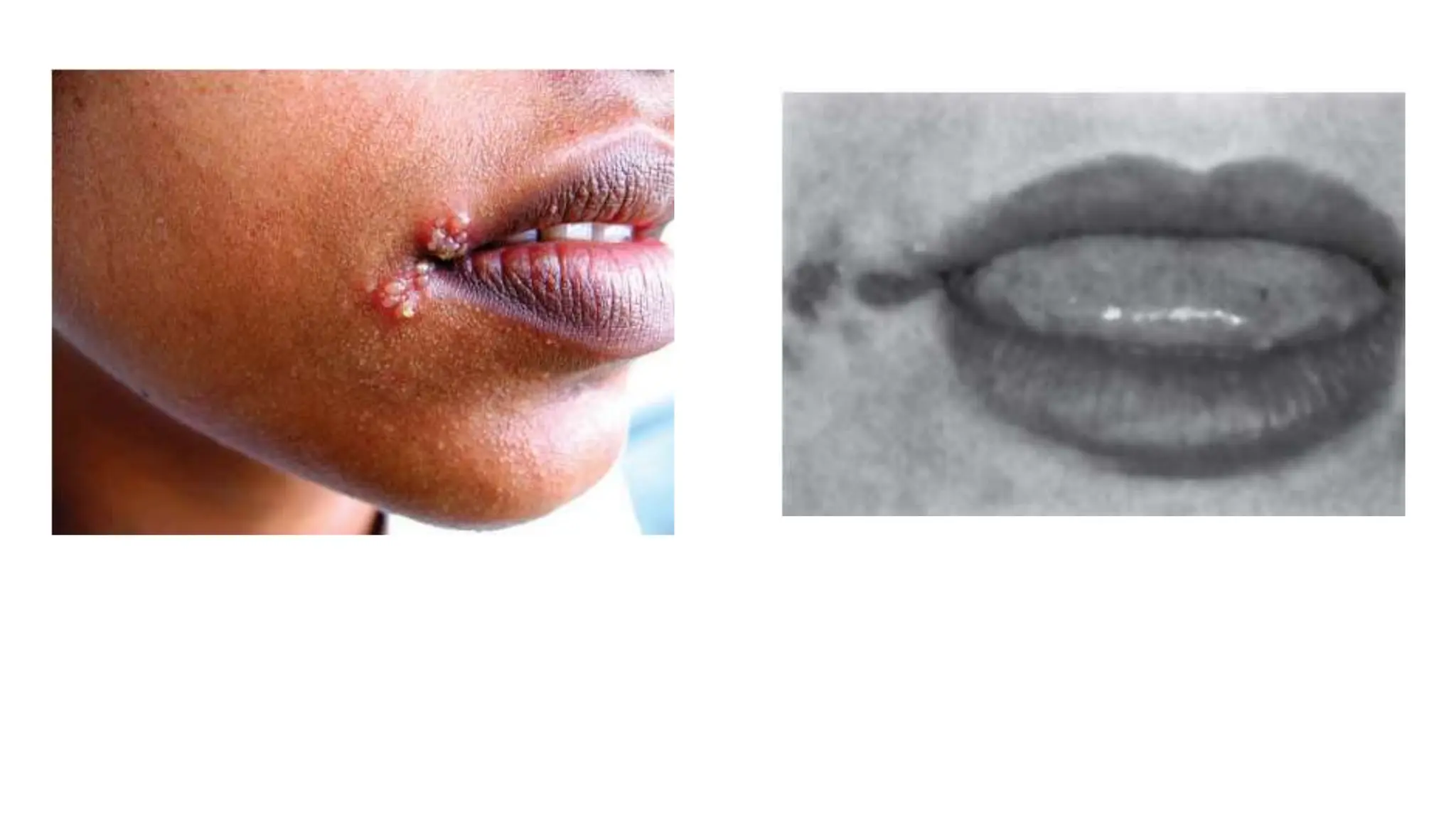 Viral Infections of the oral cavity for dental students | PPTX