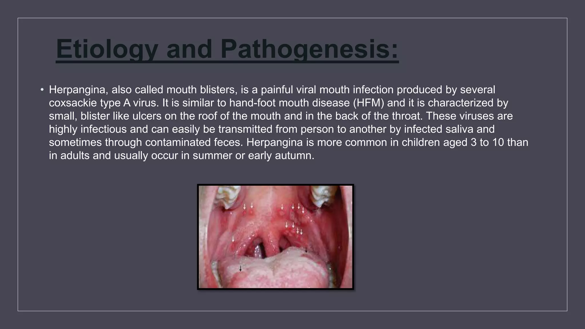 Viral infections in the oral cavity | PPTX
