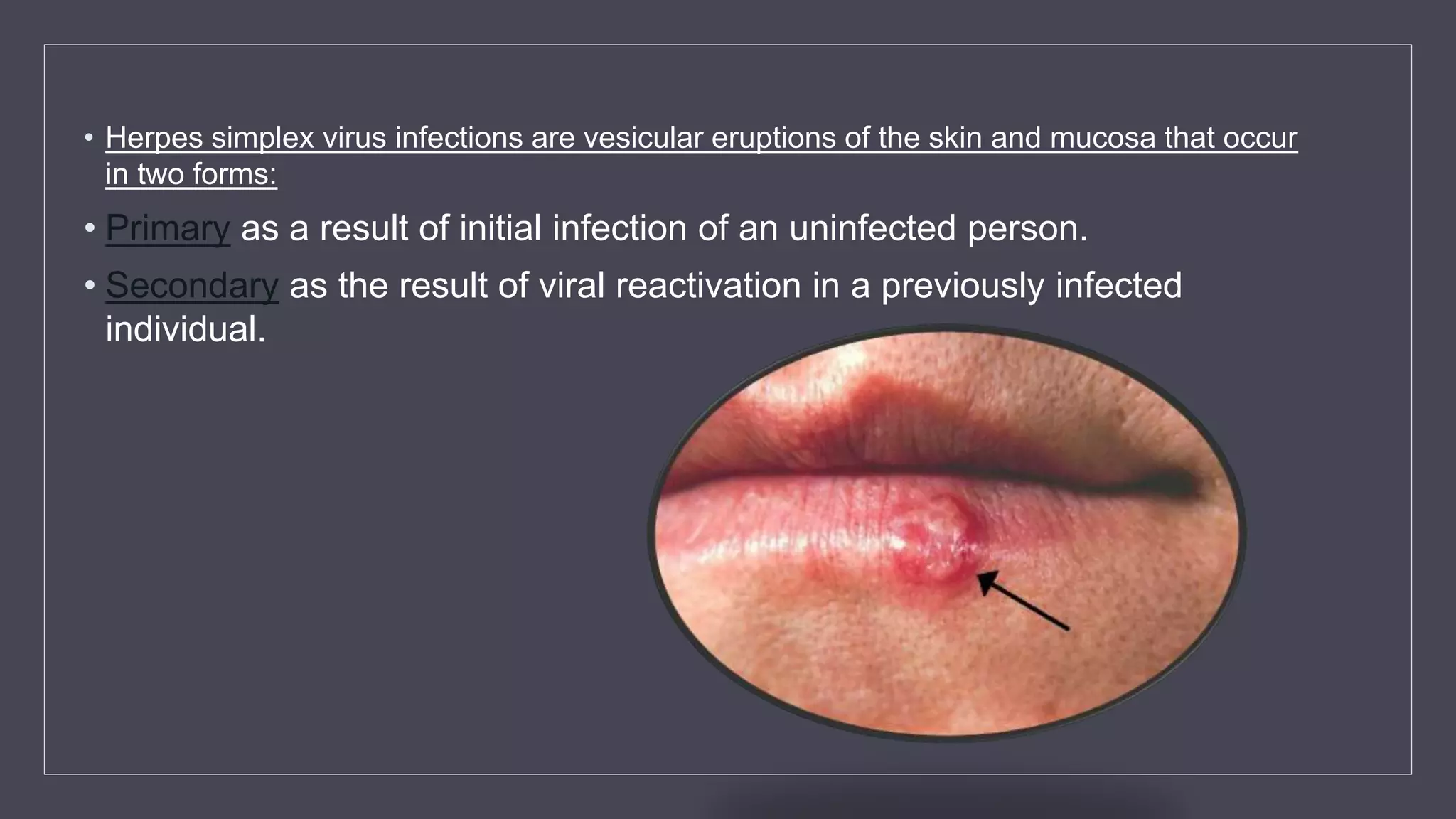 Viral infections in the oral cavity | PPTX