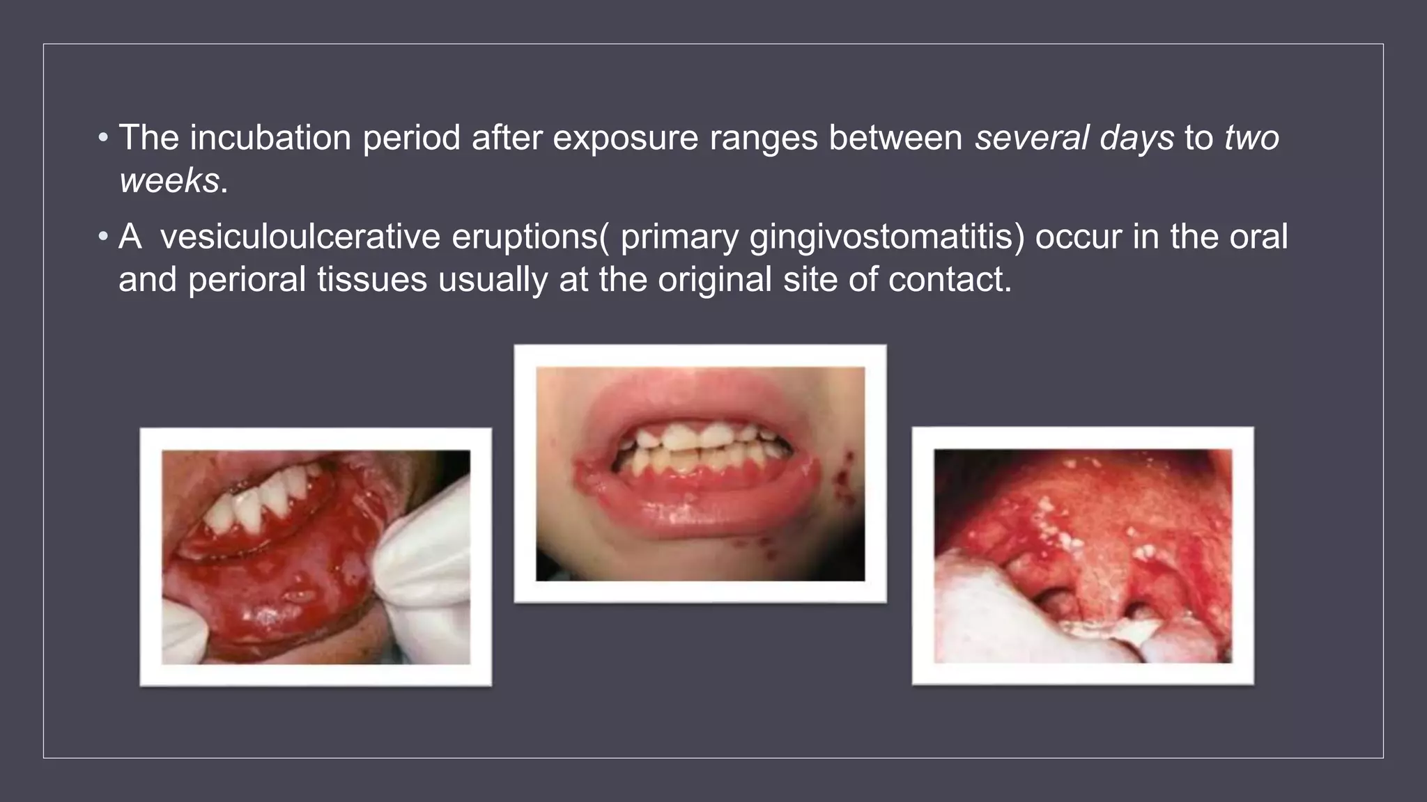 Viral infections in the oral cavity | PPTX