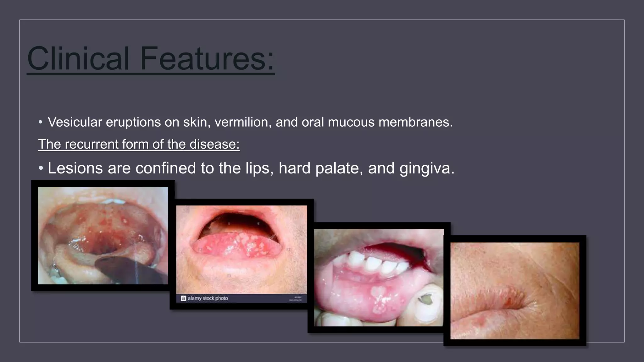 Viral infections in the oral cavity | PPTX