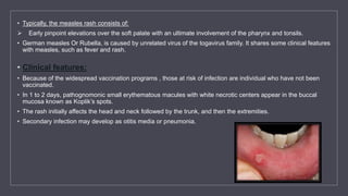 Viral infections in the oral cavity | PPTX
