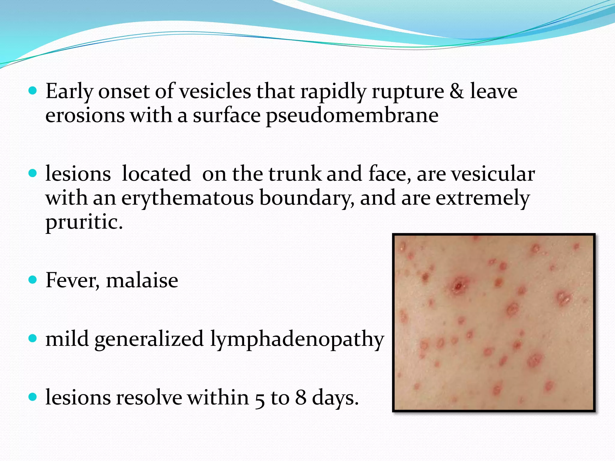 Viral infections of oral cavity - Dr. Abhishek Solanki | PPTX