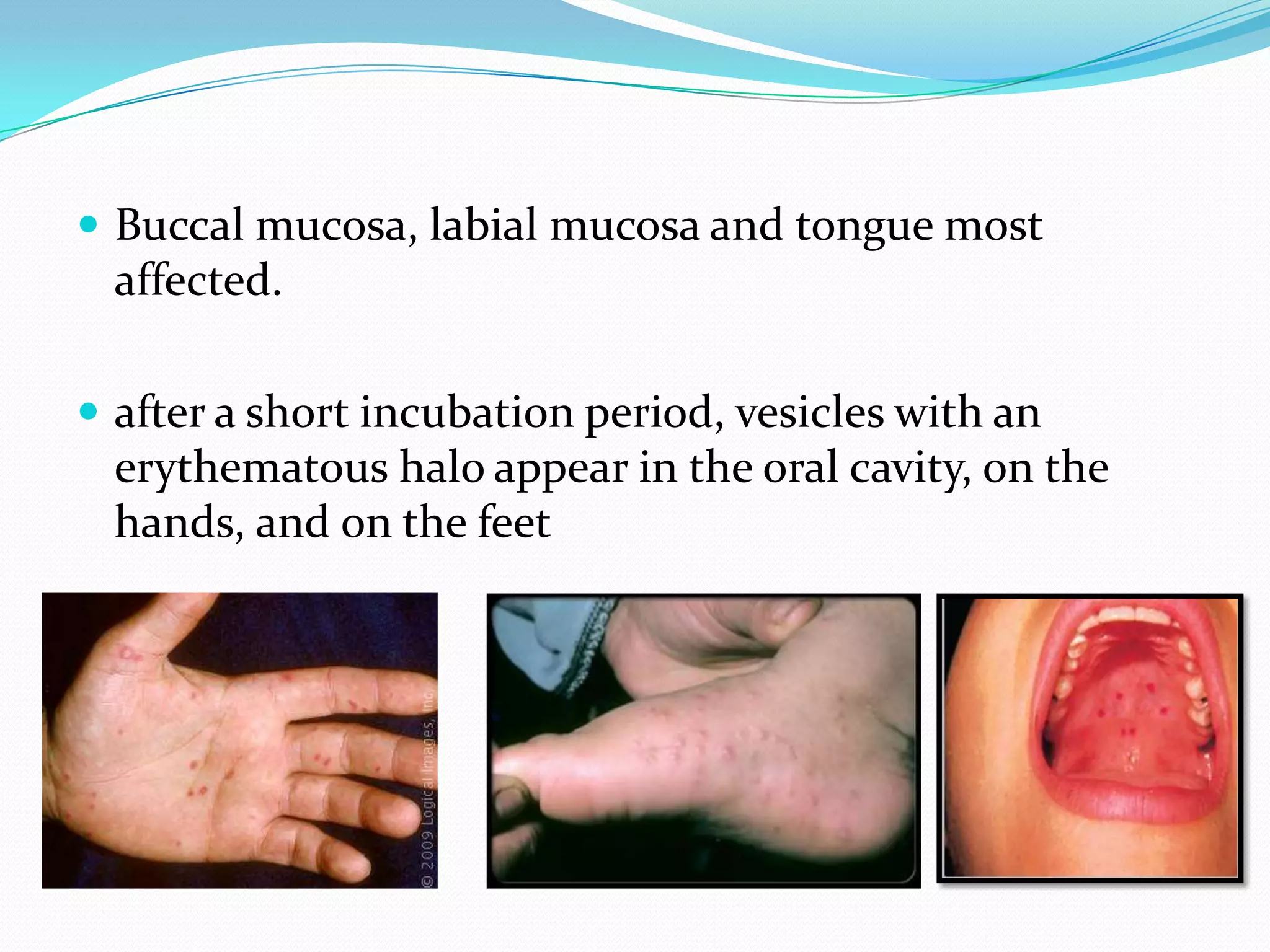Viral infections of oral cavity - Dr. Abhishek Solanki | PPTX