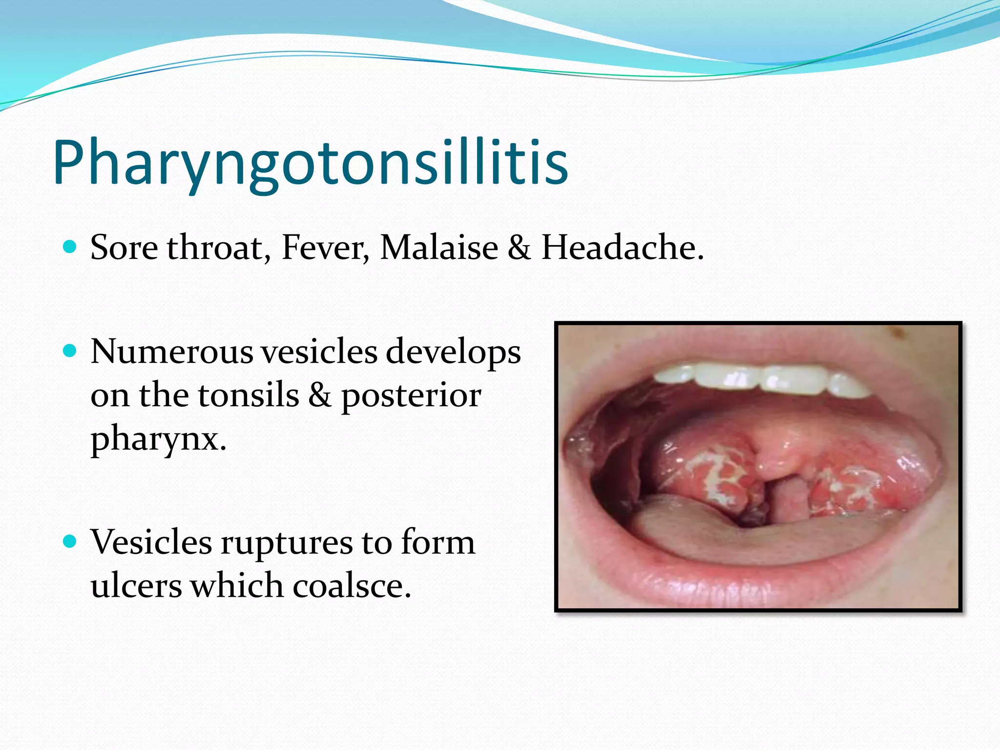 Viral infections of oral cavity - Dr. Abhishek Solanki | PPTX