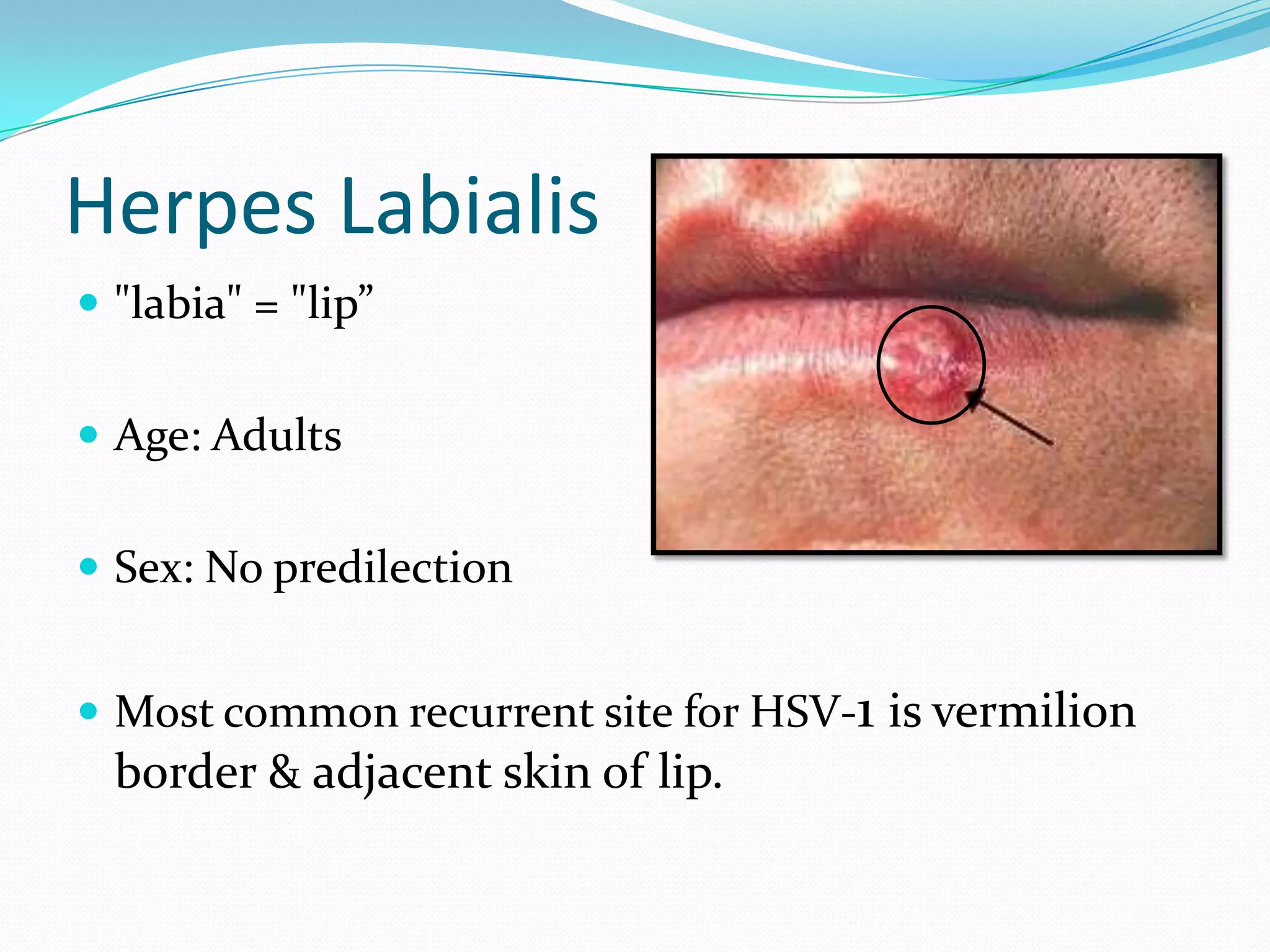 Viral infections of oral cavity - Dr. Abhishek Solanki | PPTX