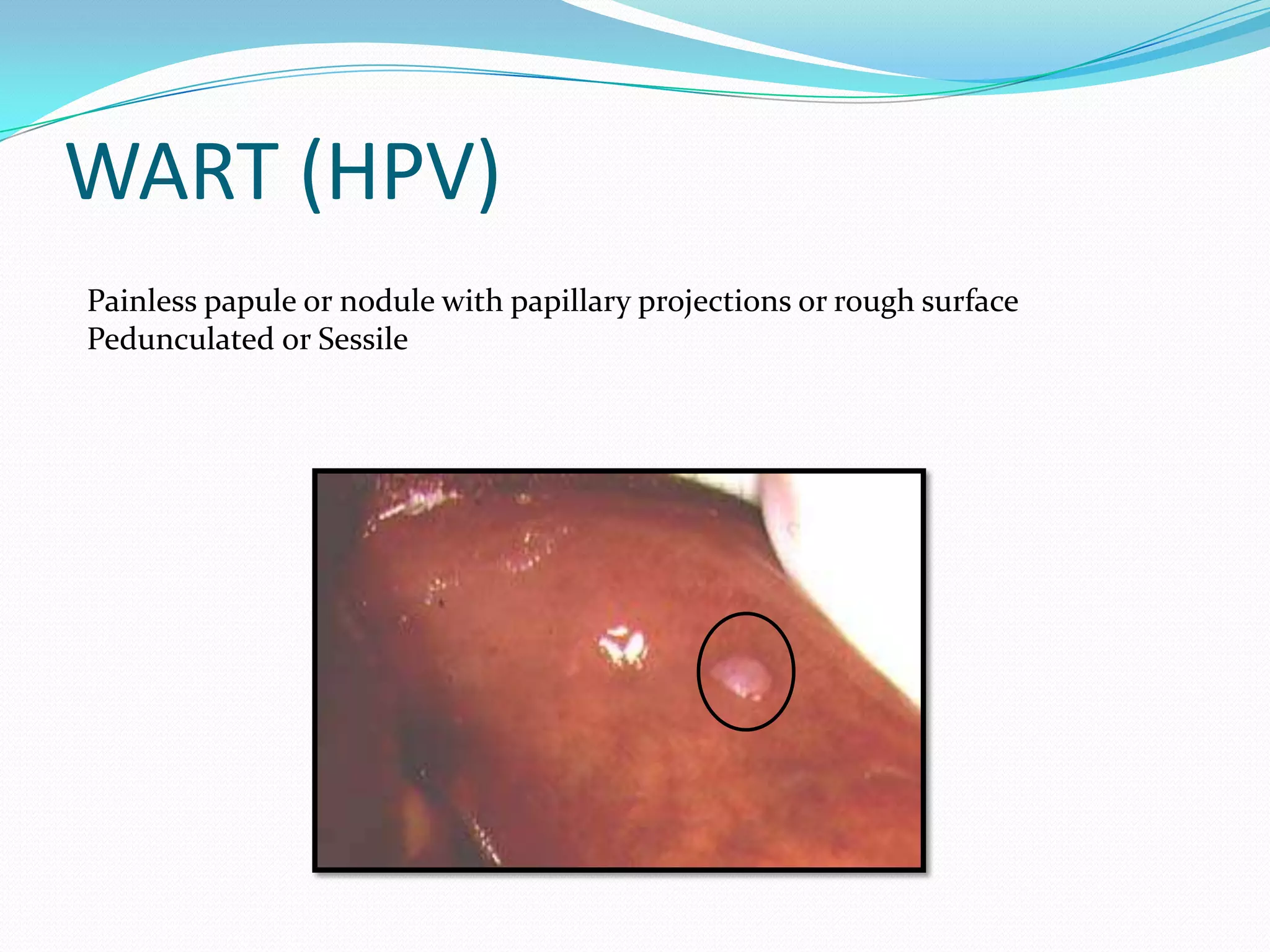 Viral infections of oral cavity - Dr. Abhishek Solanki | PPTX