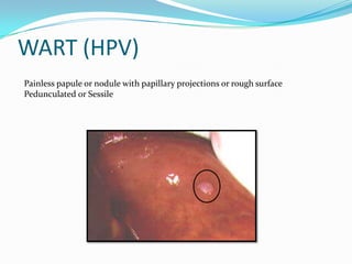 Viral infections of oral cavity - Dr. Abhishek Solanki | PPTX