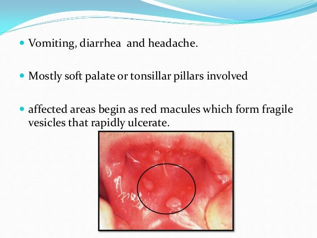 Viral infections of oral cavity - Dr. Abhishek Solanki