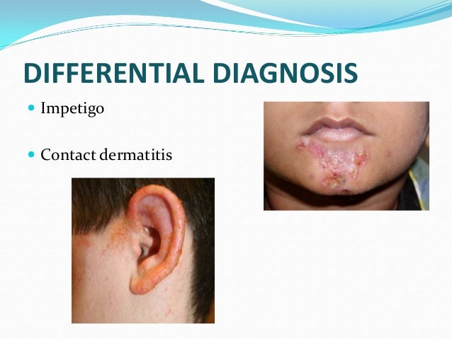 Viral infections of oral cavity - Dr. Abhishek Solanki Viral infections of oral cavity - Dr. Abhishek Solanki