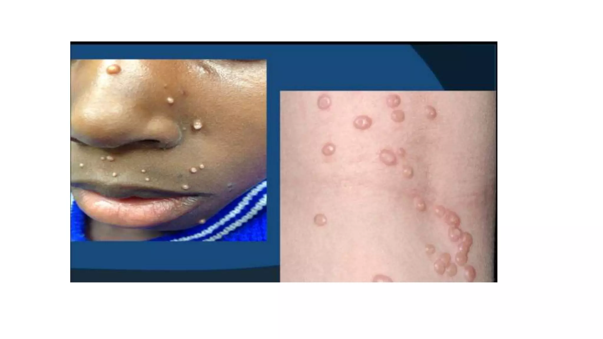 Viral infections of the skin | PPTX