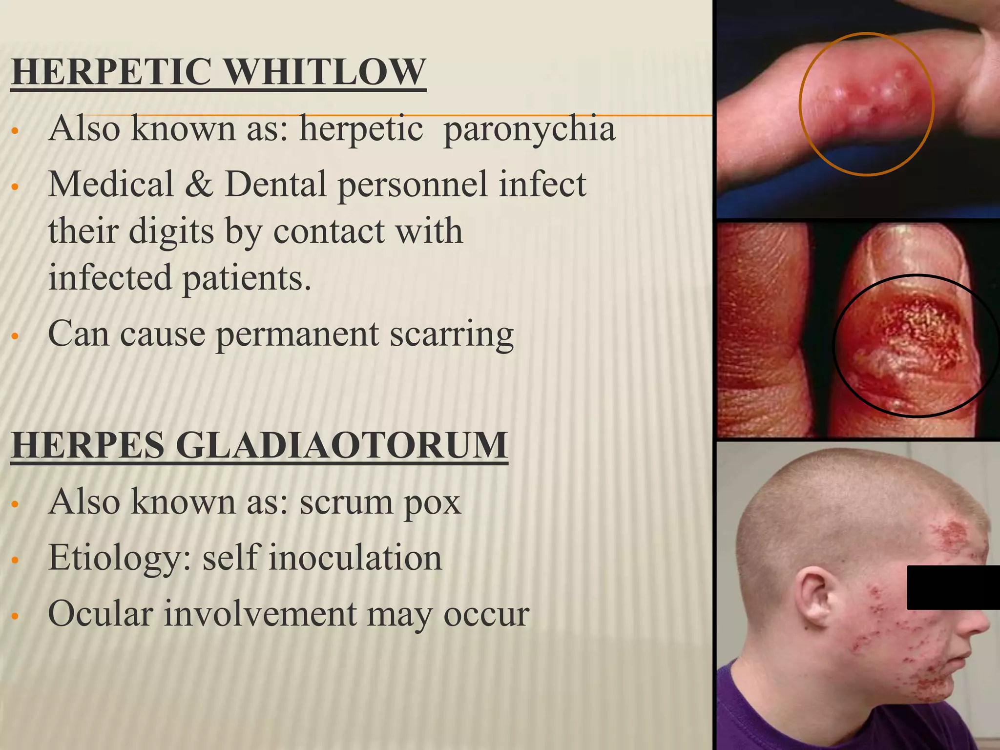 Viral infections (oral cavity) | PPTX