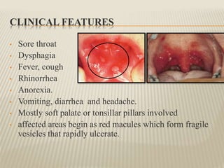 Viral infections (oral cavity) | PPTX