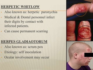 Viral infections (oral cavity) | PPTX