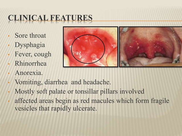 Viral infections (oral cavity)
