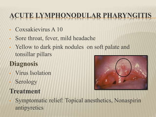 Acute Lymphonodular Pharyngitis