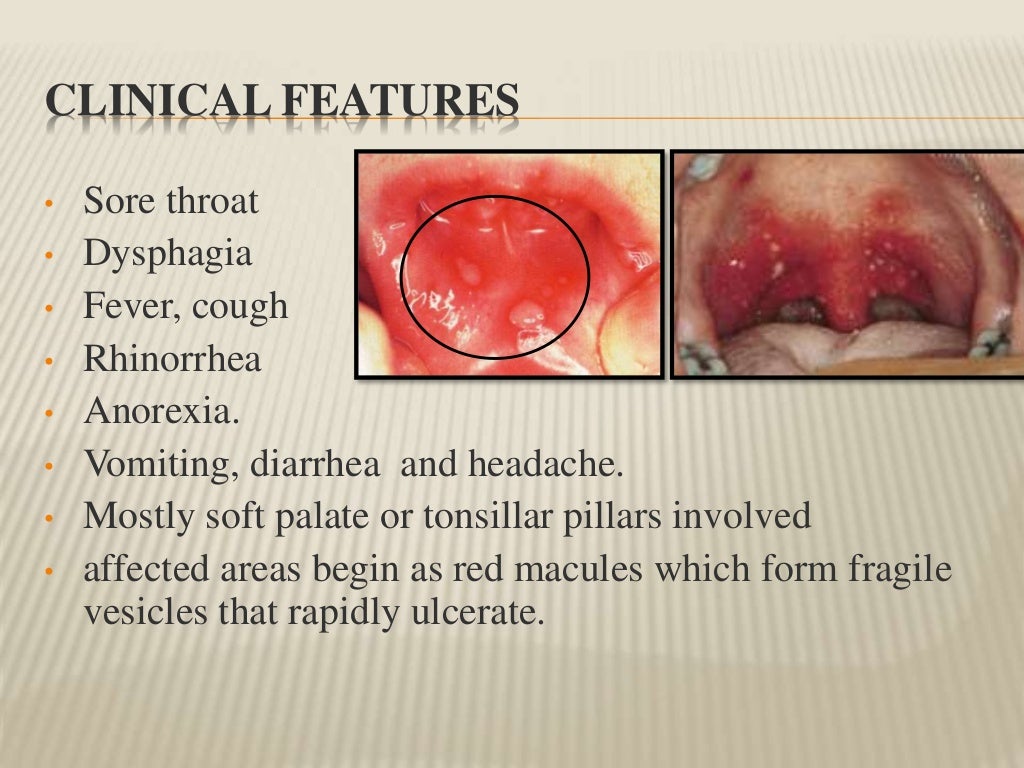 Viral infections (oral cavity)