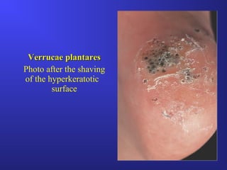 Verrucae Plantares