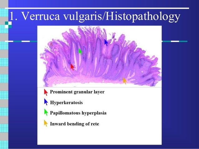 Viral infections-Human papillomaviruses infection