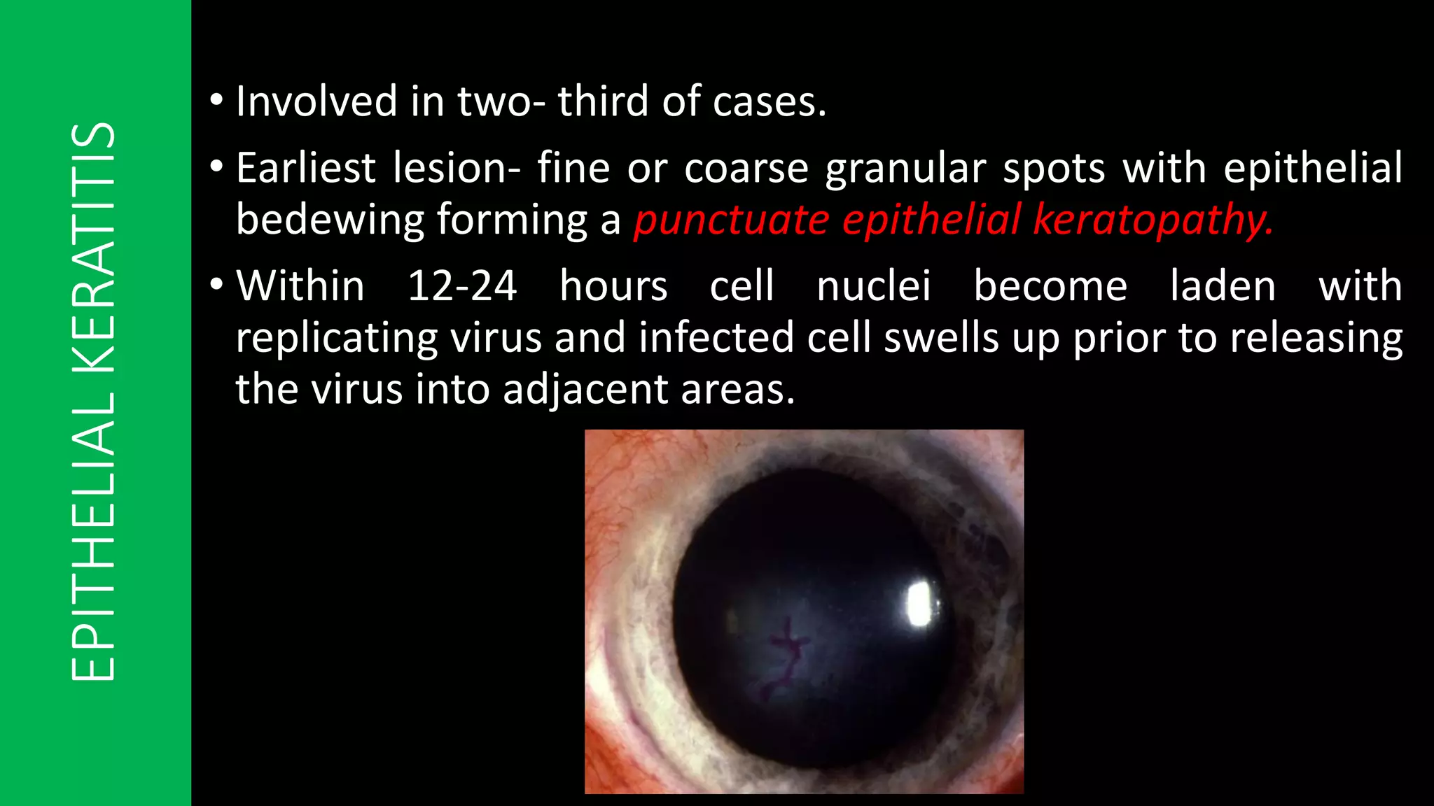 Viral Keratitis: Diagnosis, Management and Latest Guidelines | PPTX