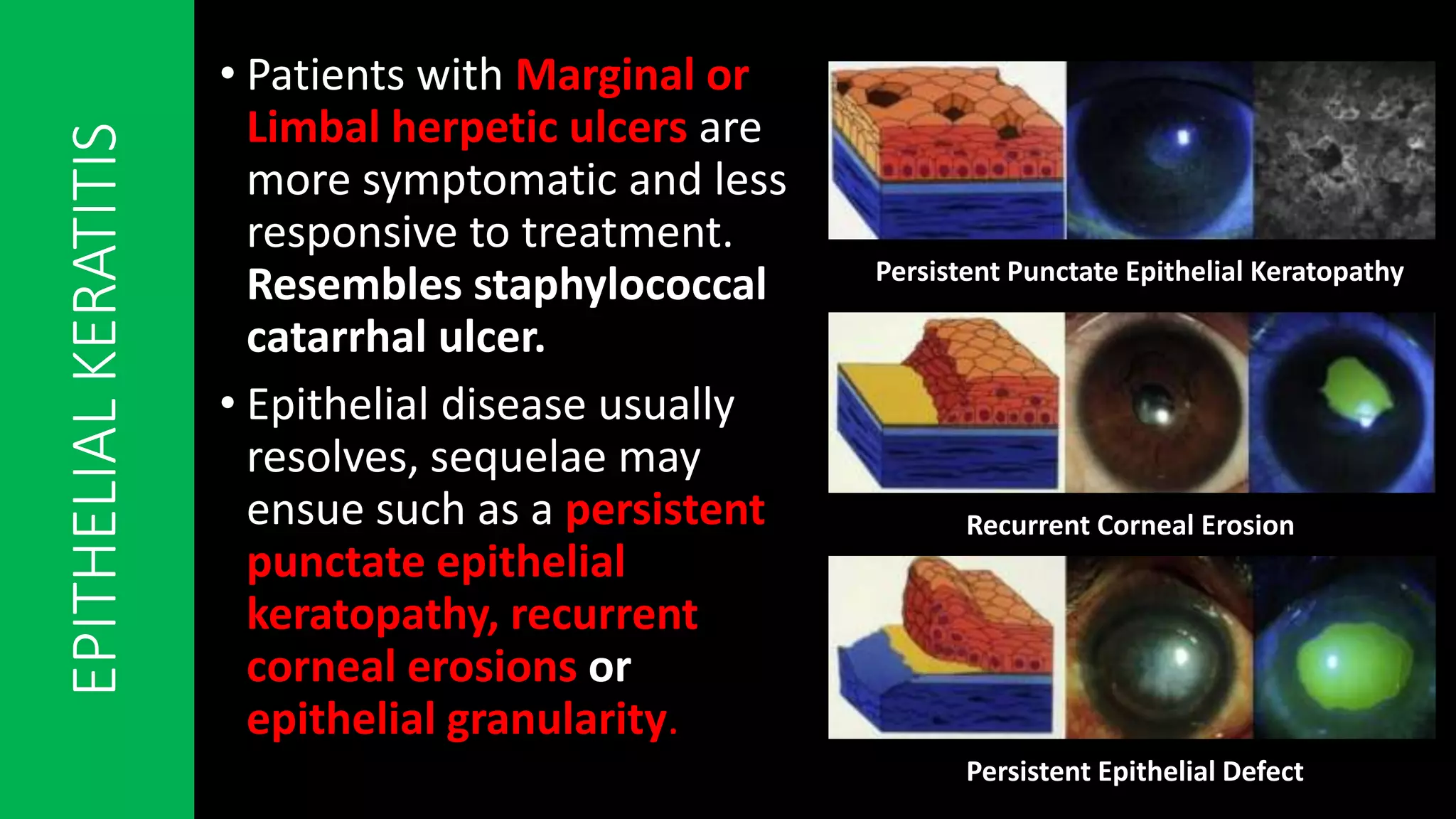 Viral Keratitis: Diagnosis, Management and Latest Guidelines | PPTX