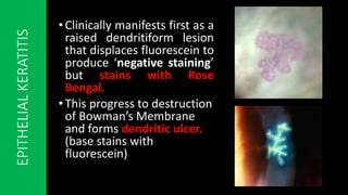 Viral Keratitis: Diagnosis, Management and Latest Guidelines | PPTX