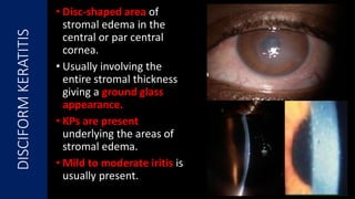 Disciform Keratitis