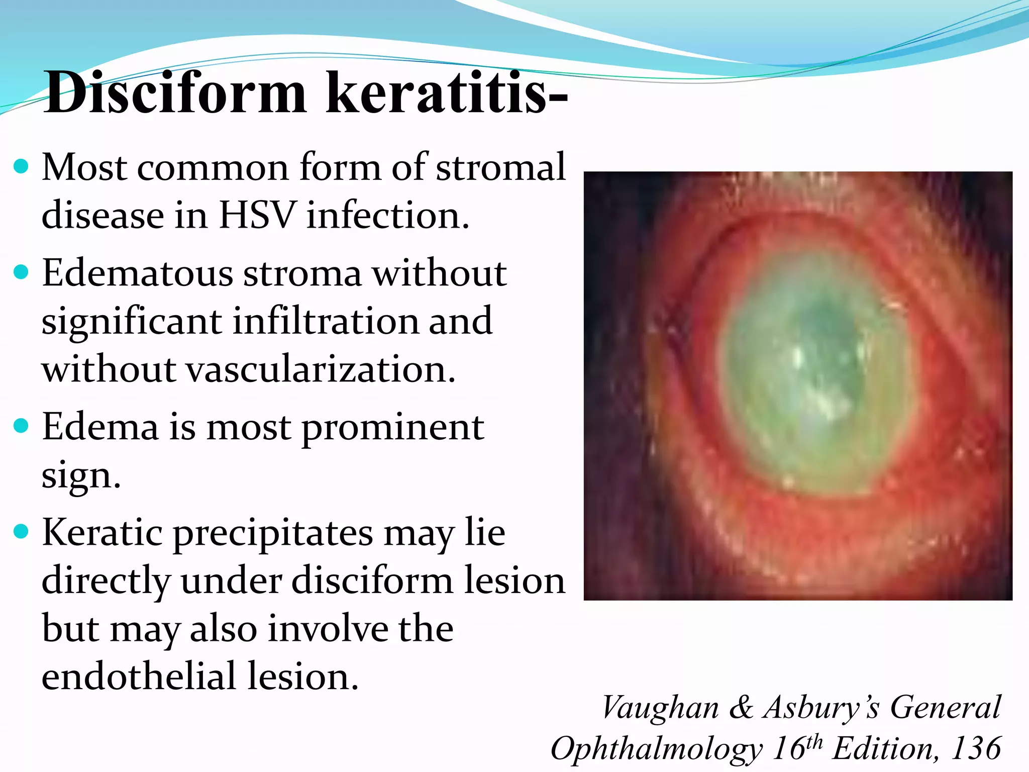 Viral keratitis | PPT