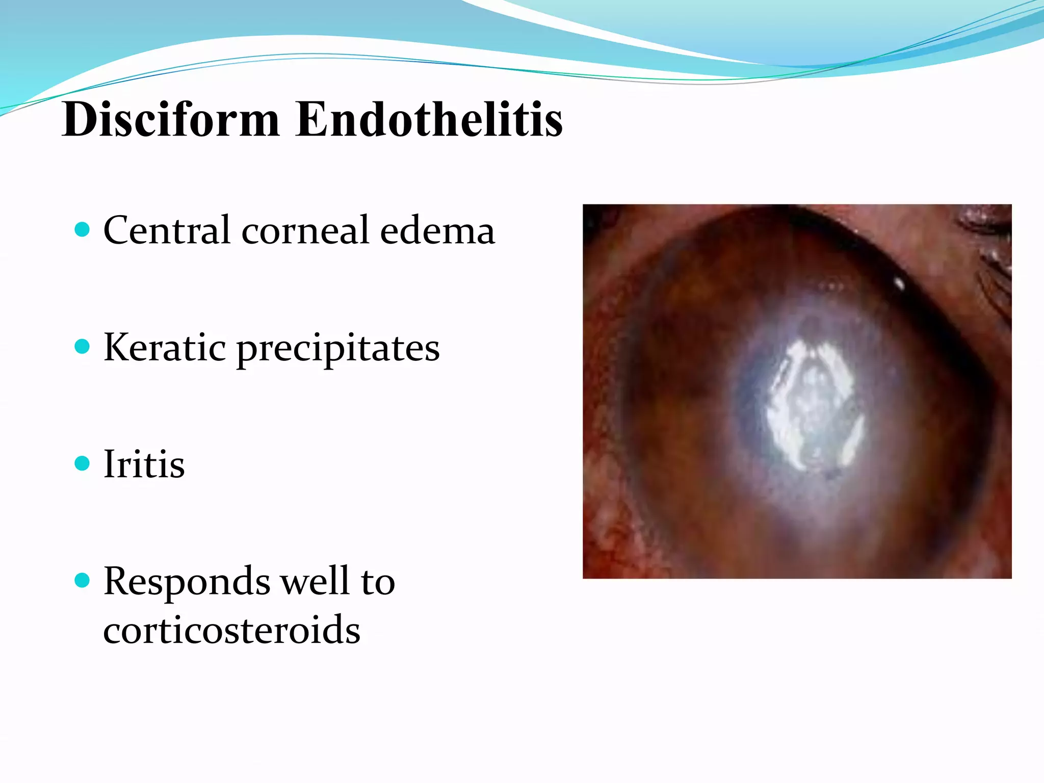 Viral keratitis | PPT