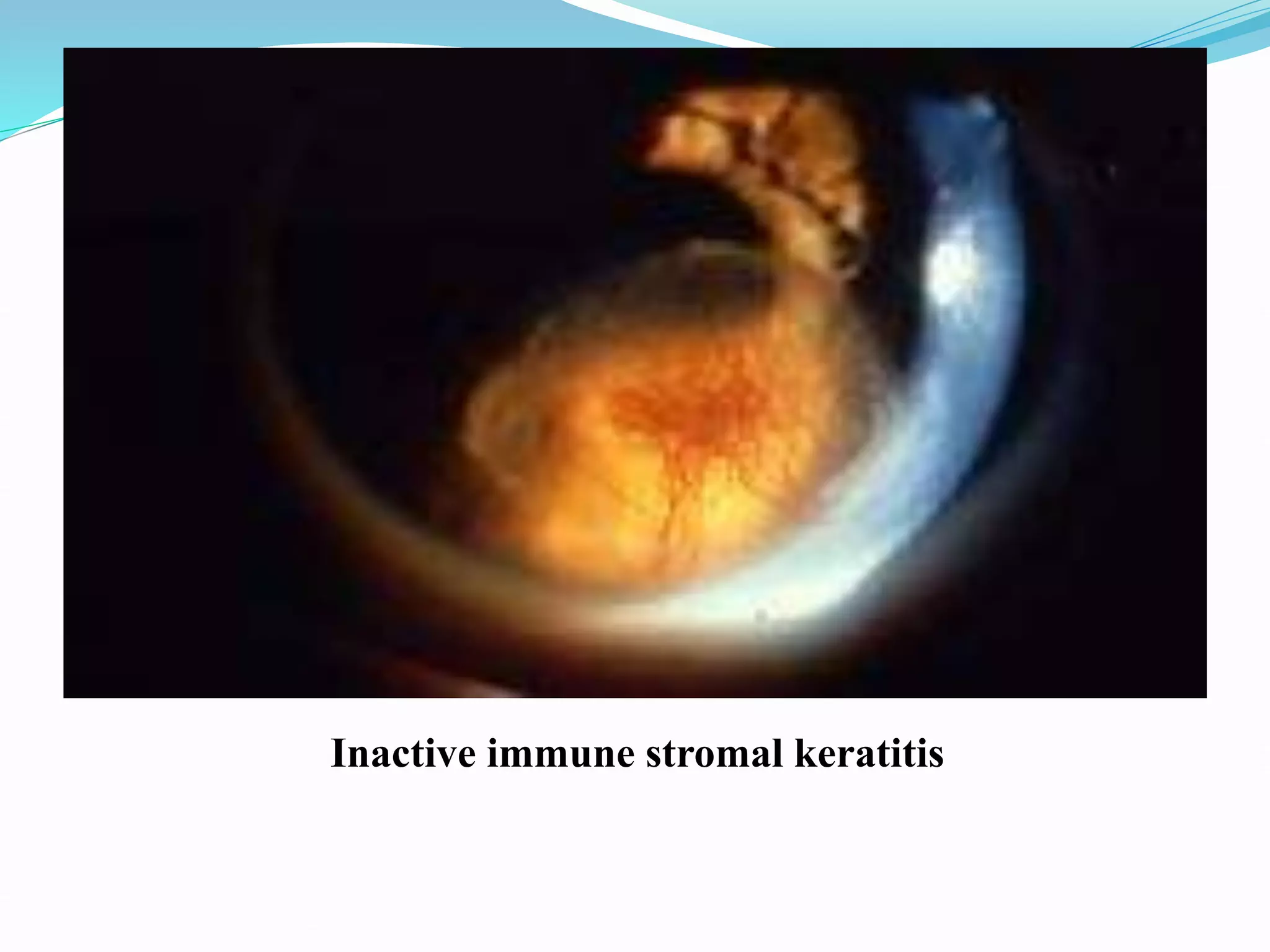 Viral keratitis | PPT