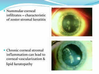 Viral keratitis | PPT