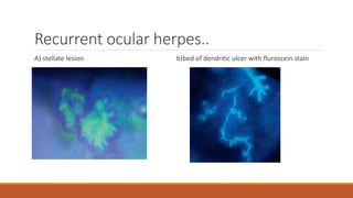 Viral keratitis pathogenesis | PPTX