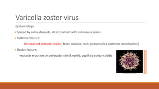 Viral keratitis pathogenesis | PPTX