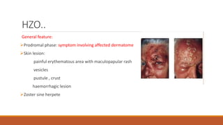 Viral keratitis pathogenesis | PPTX