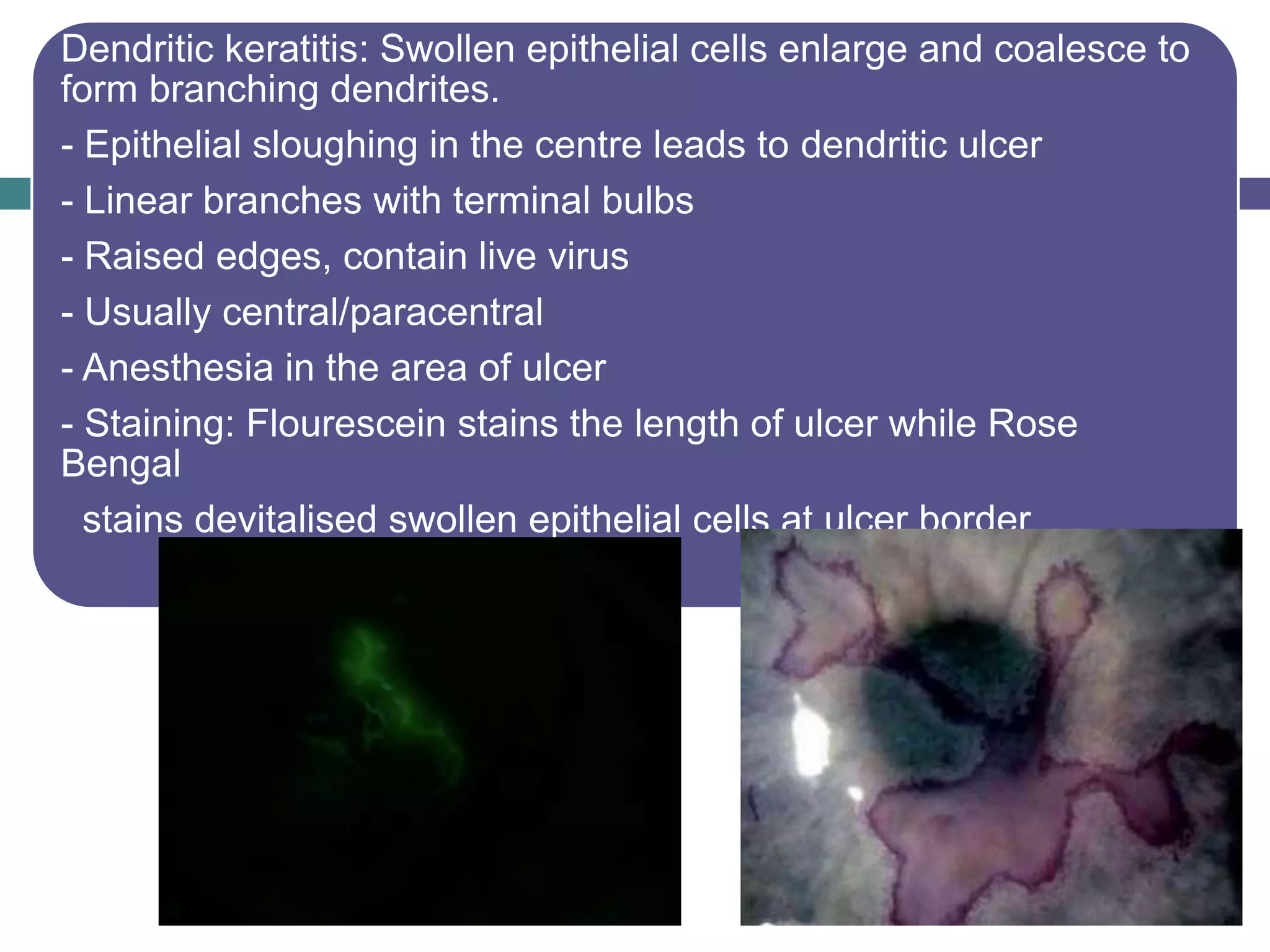 Viral keratitis: Diagnosis and management | PPTX