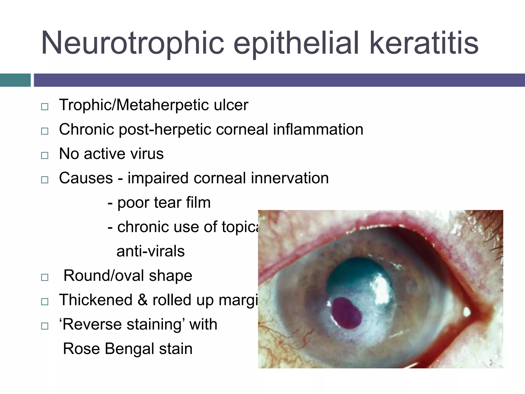 Viral keratitis: Diagnosis and management | PPTX