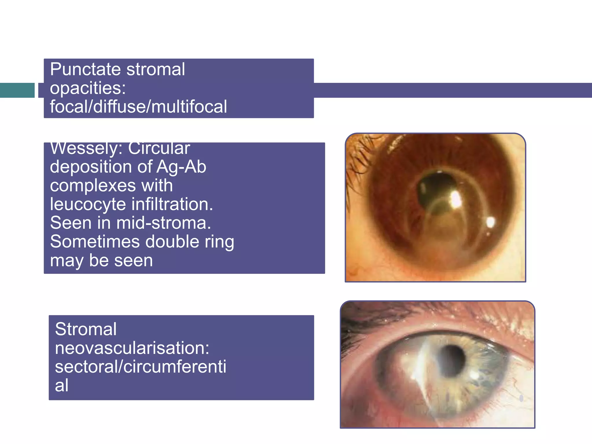 Viral keratitis: Diagnosis and management | PPTX